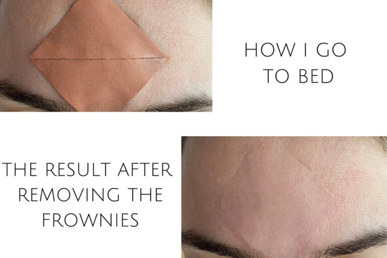 My Experience With Frownies - The Green Creator